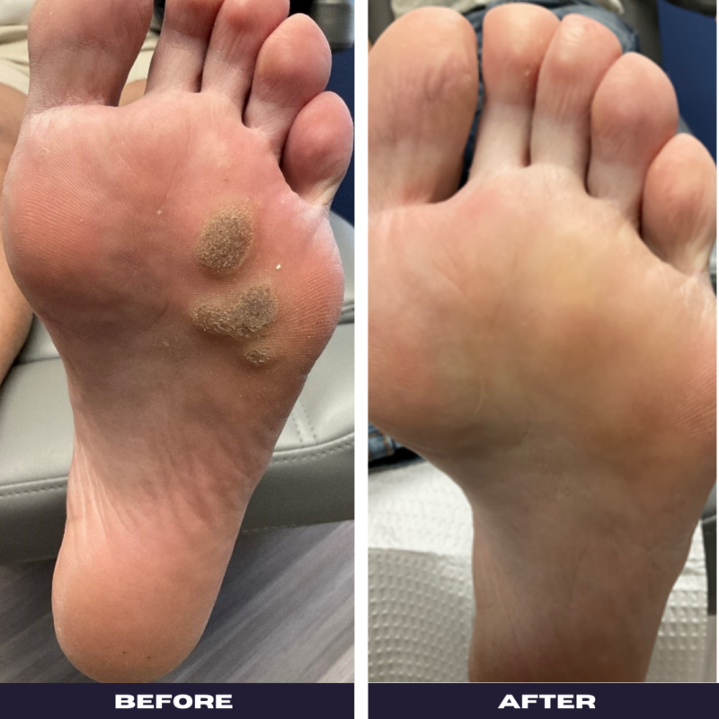 The DPM Laser - Remy Laser