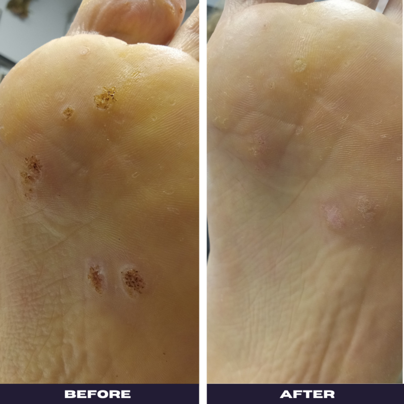 The DPM Laser - Remy Laser