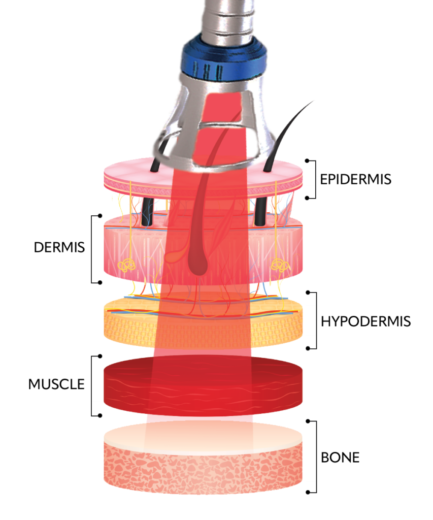 Therapy - Remy Laser