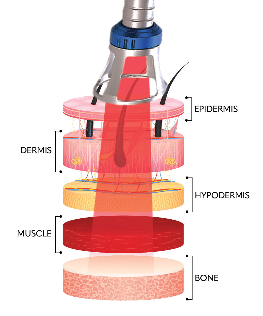 Therapy - Remy Laser